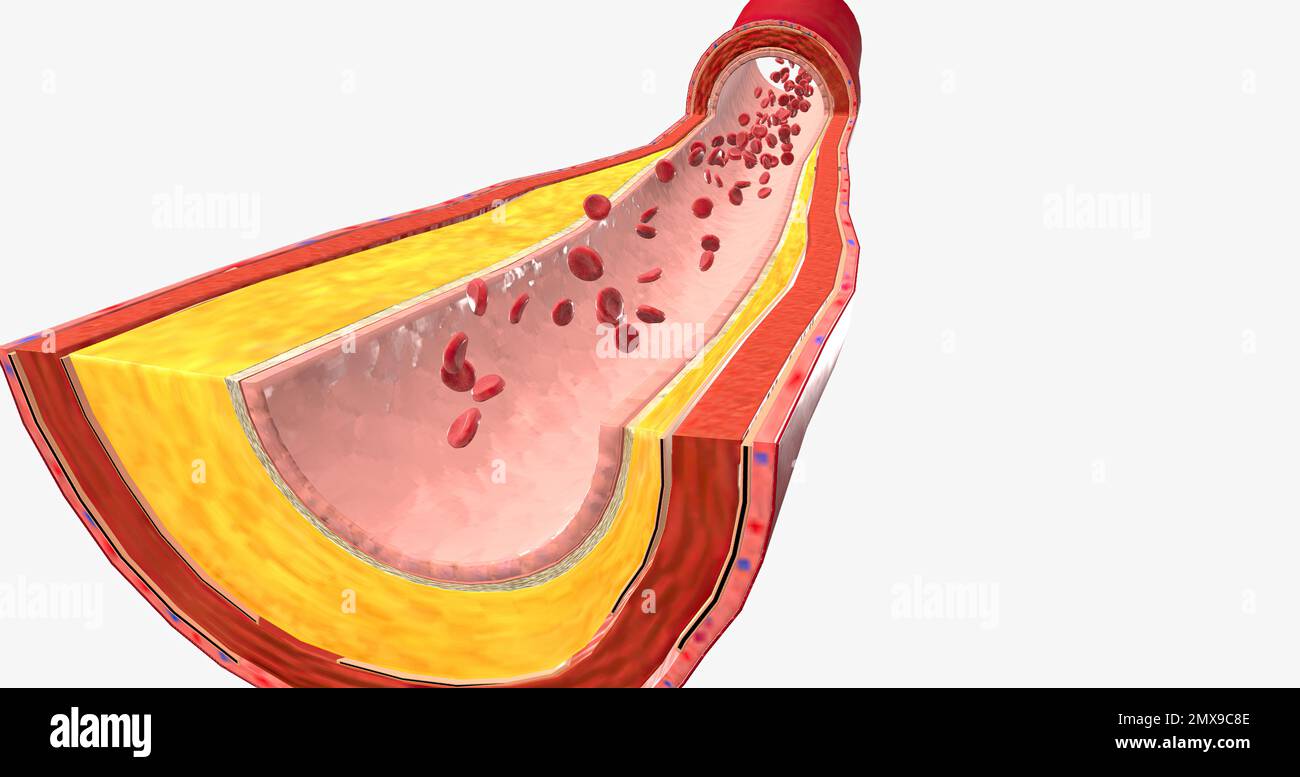 Healthy and atherosclerotic arteries hi-res stock photography and ...