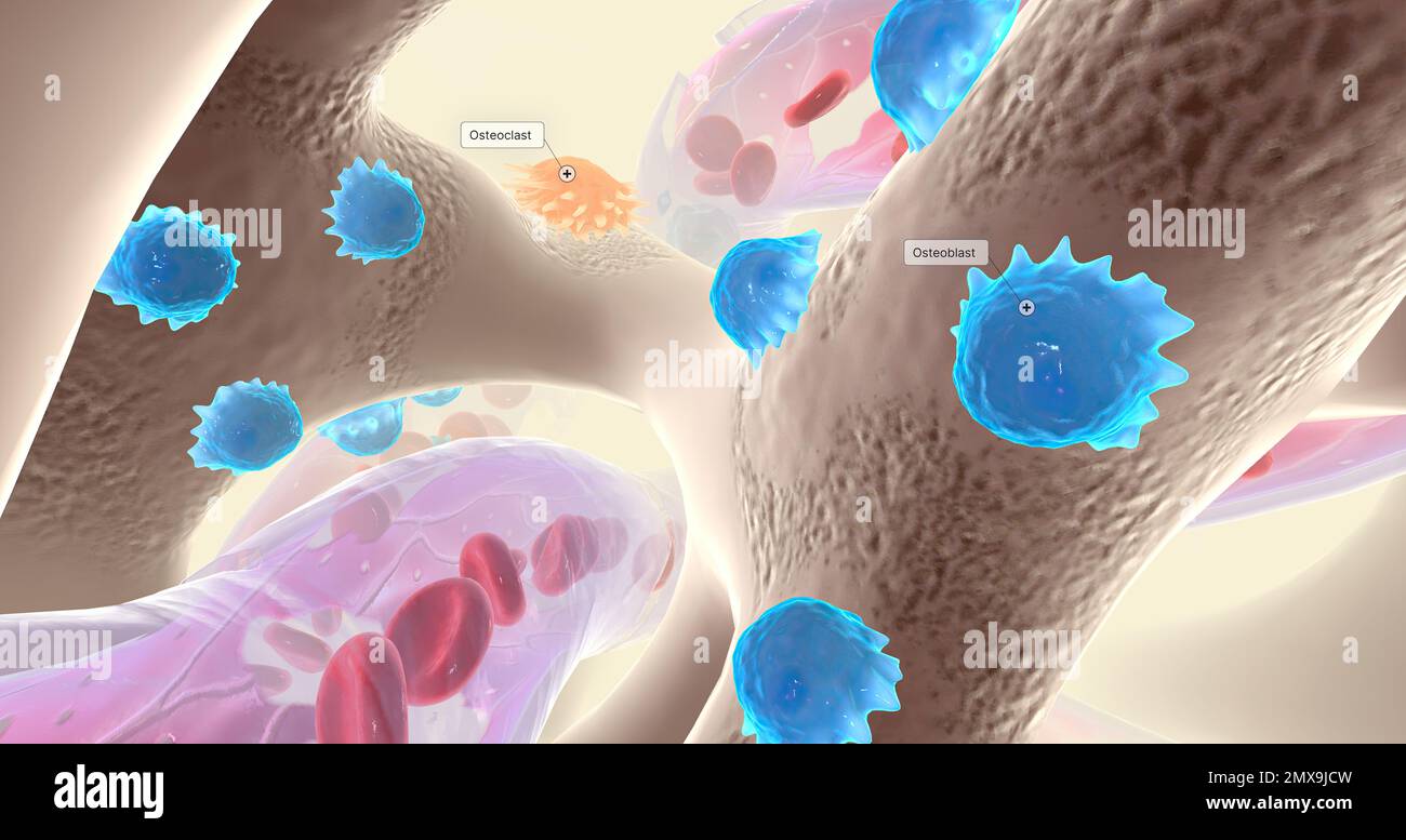 Multiple myeloma skeleton hi-res stock photography and images - Alamy