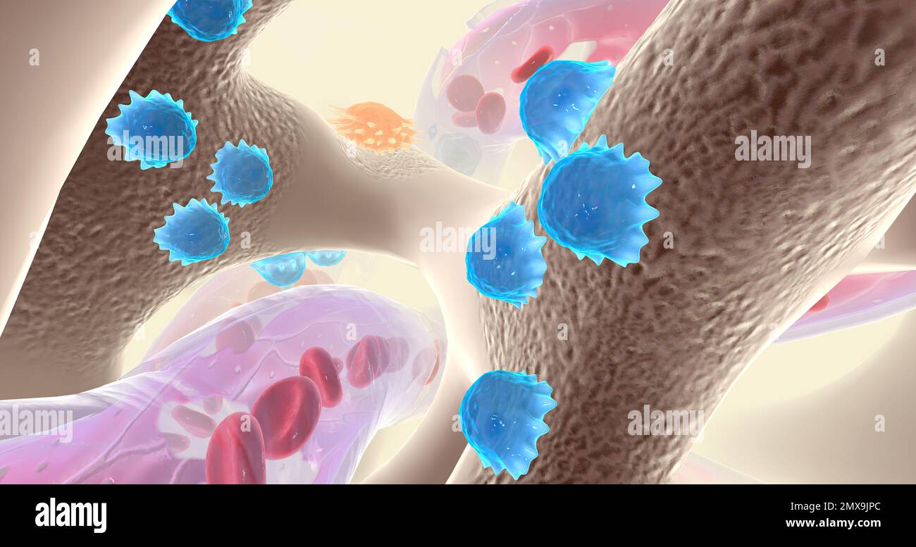 Multiple myeloma skeleton hi-res stock photography and images - Alamy