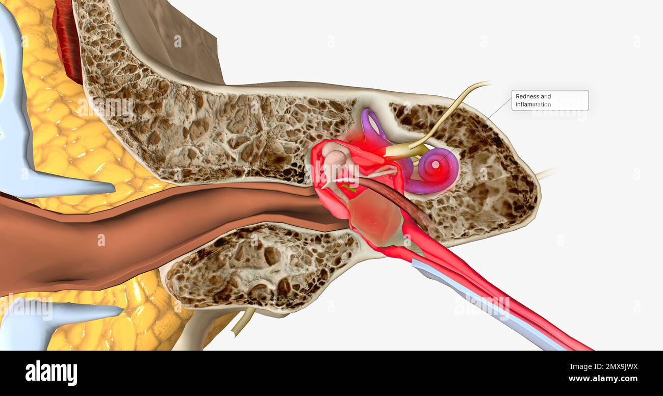 Labyrinthitis hi-res stock photography and images - Alamy