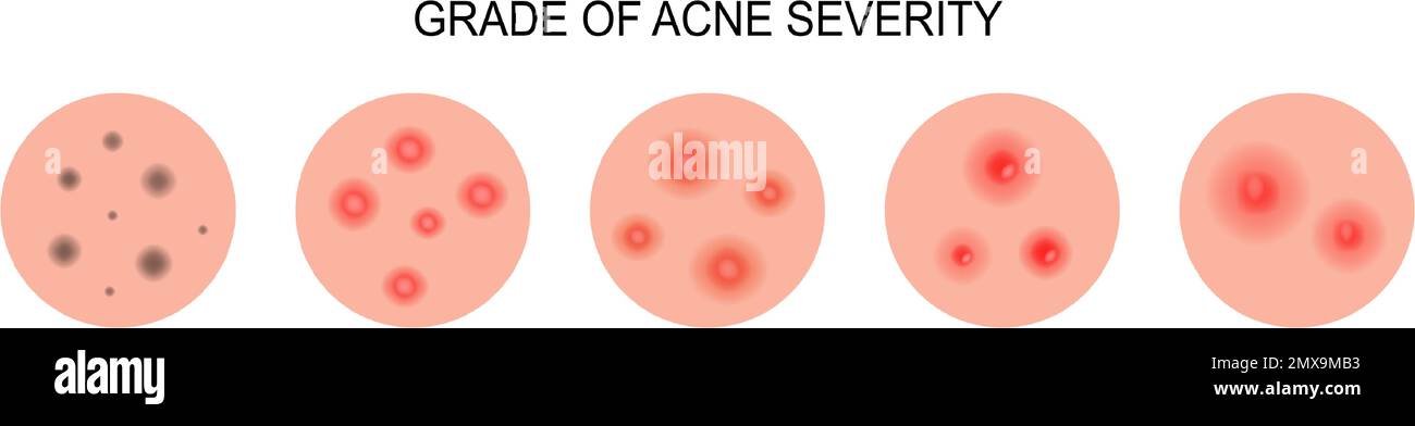 Grade of acne severity. Medical diagram different types acne ...