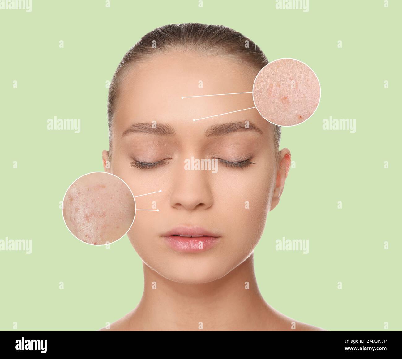 Young woman with acne problem on light green background Stock Photo - Alamy