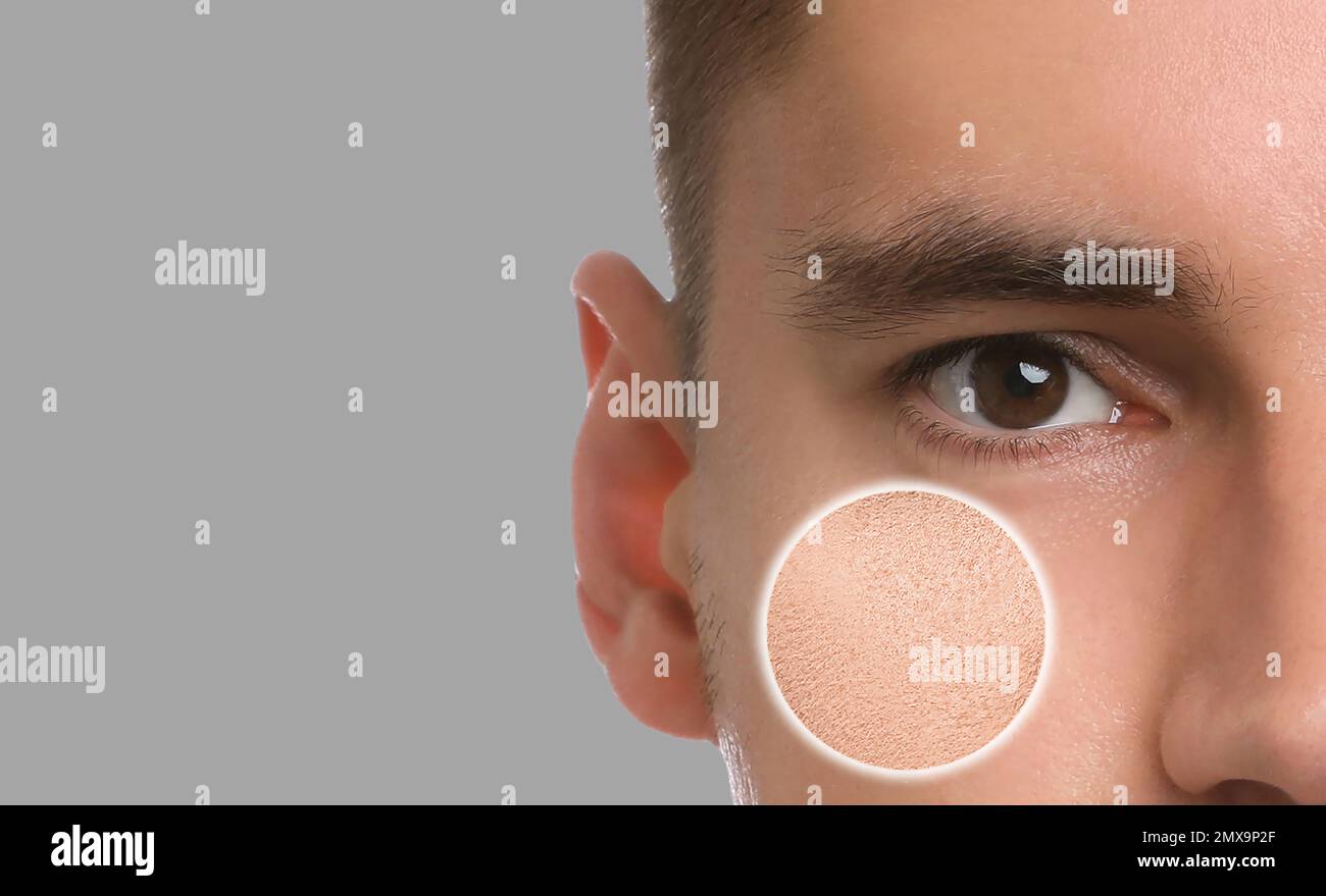 Desquamation of the skin hi-res stock photography and images - Alamy