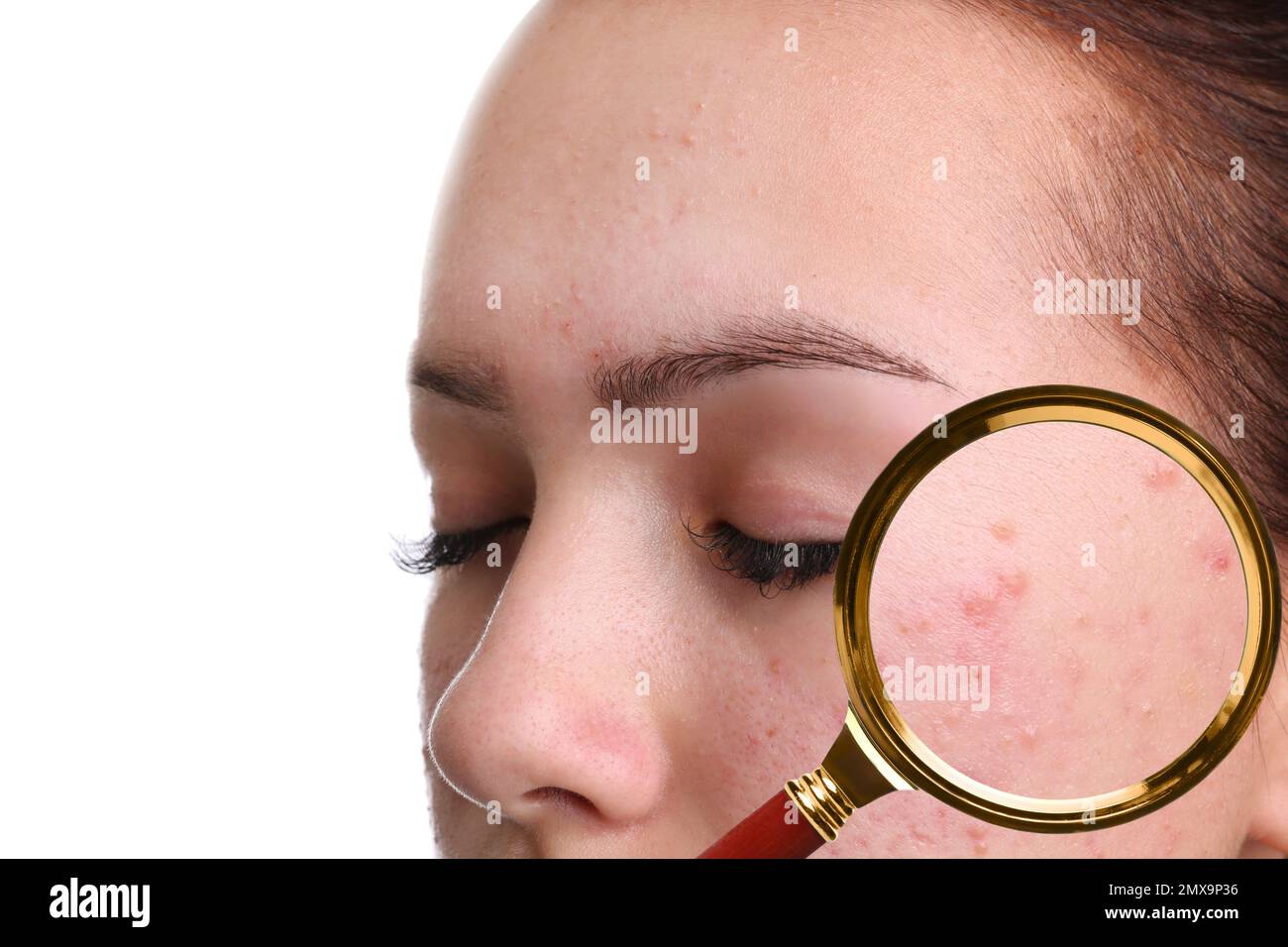 Teenage girl with acne problem on white background, closeup. Skin under ...