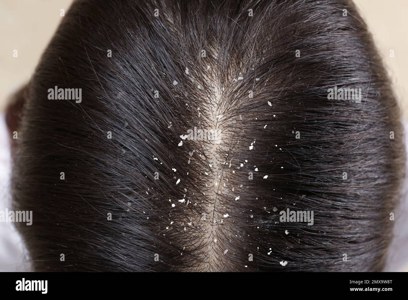 Woman dandruff shampoo hi-res stock photography and images - Alamy