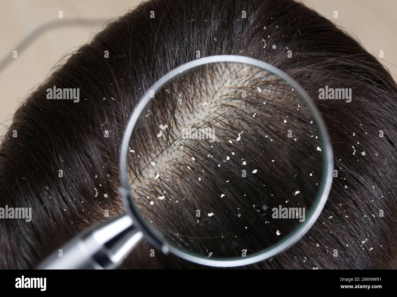 Woman with dandruff in her hair, closeup. View through magnifying glass ...