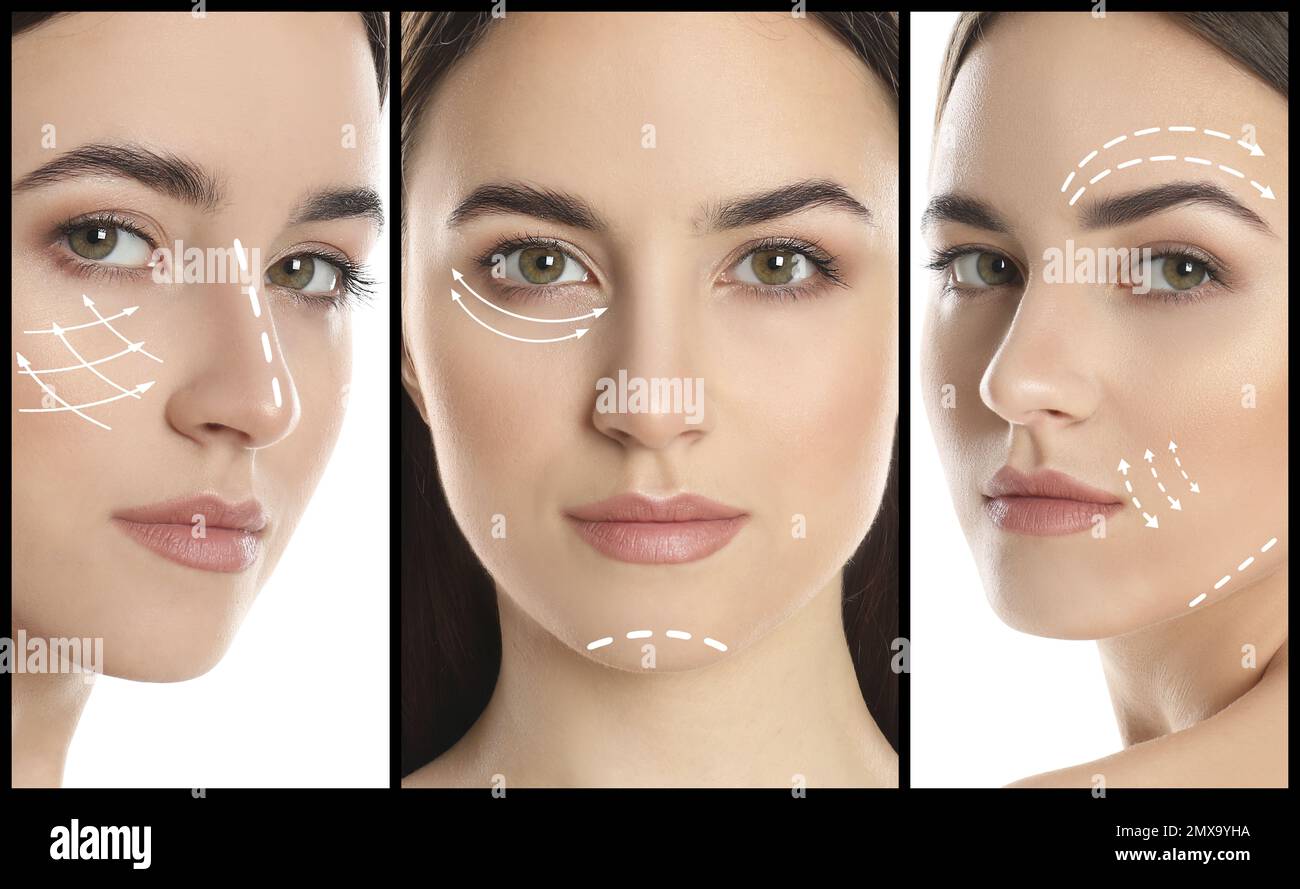 Photos of young woman with lifting marks on face against white ...