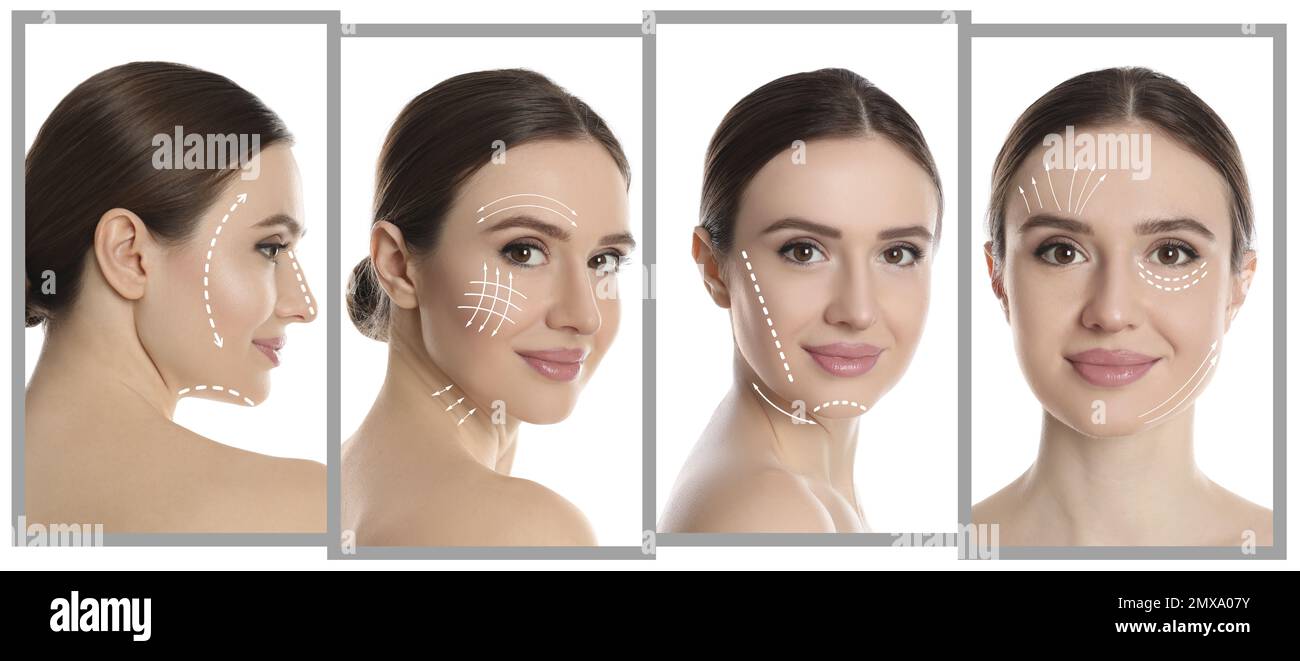 Photos of young woman with lifting marks on face against white ...