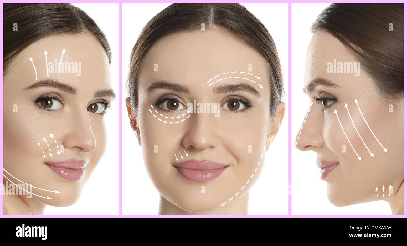 Photos of young woman with lifting marks on face against white ...