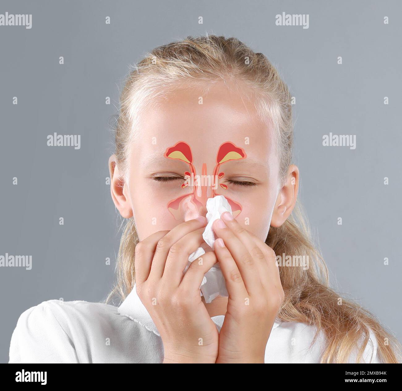 Little girl suffering from runny nose as allergy symptom. Sinuses ...