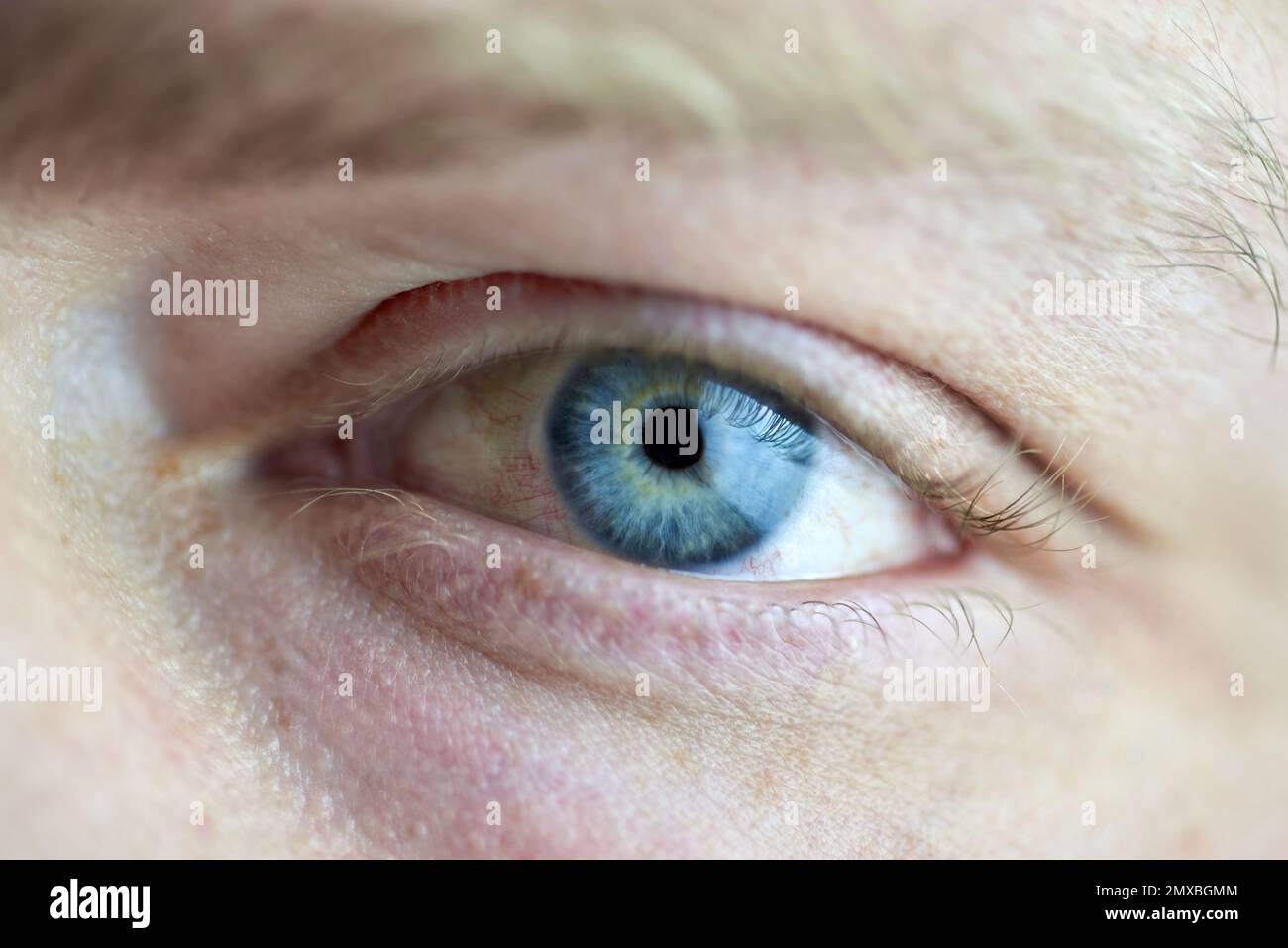 Macro photo of a male blue eye with eyeball disease Stock Photo - Alamy