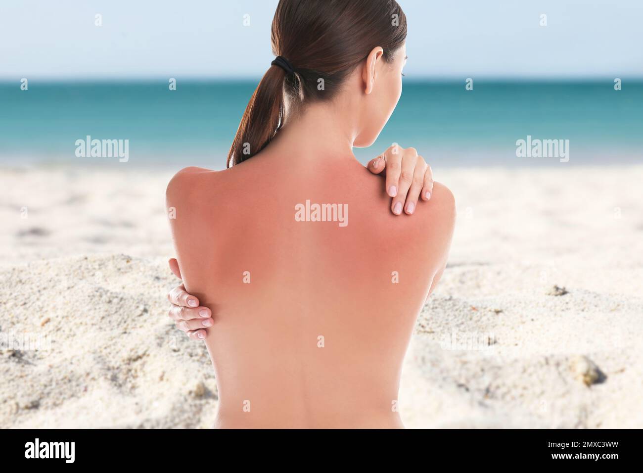 Woman With Sunburn On Beach Skin Protection From Sun In Summer Stock