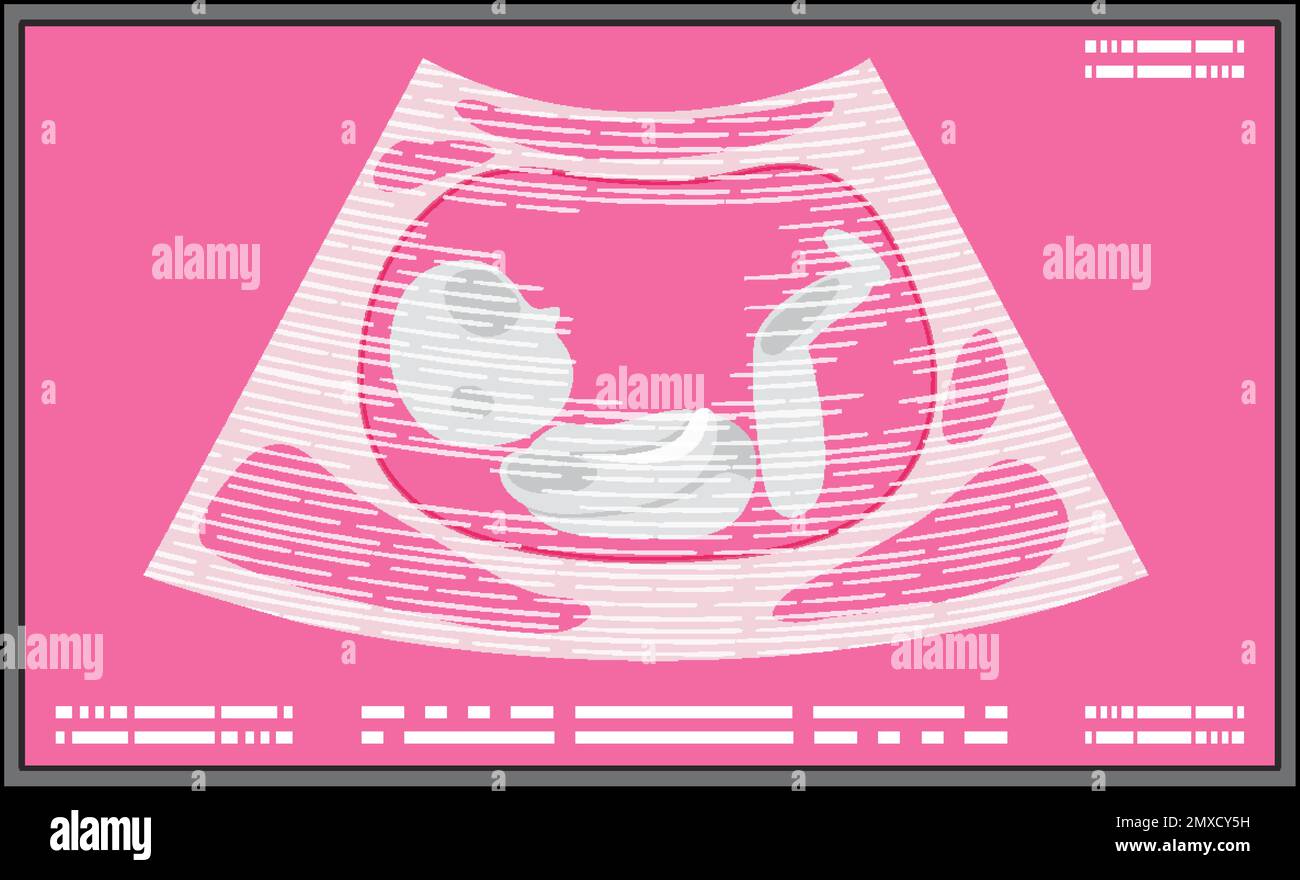 Ultrasound picture of fetus illustration Stock Vector Image & Art - Alamy