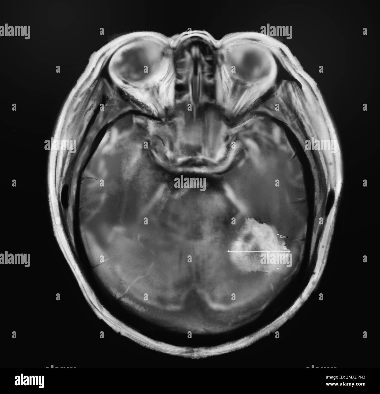 Brain Tumor Xray