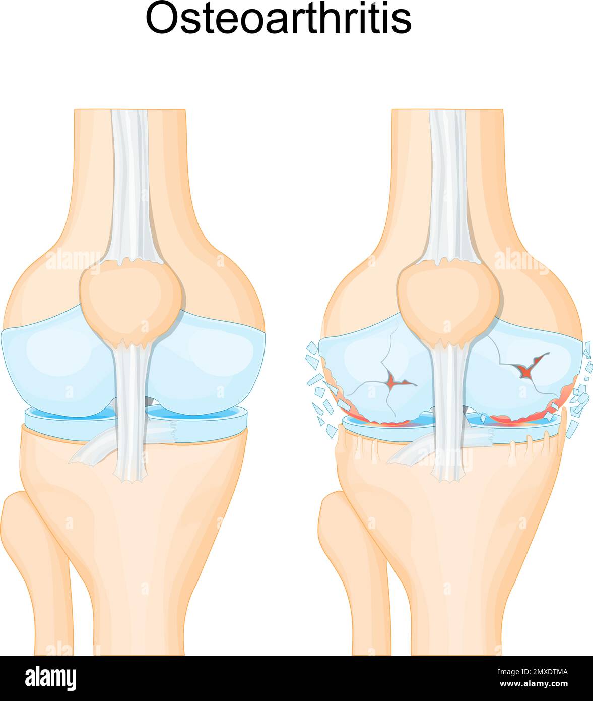 Knee Cartilage Worn Out at Shirl Wright blog
