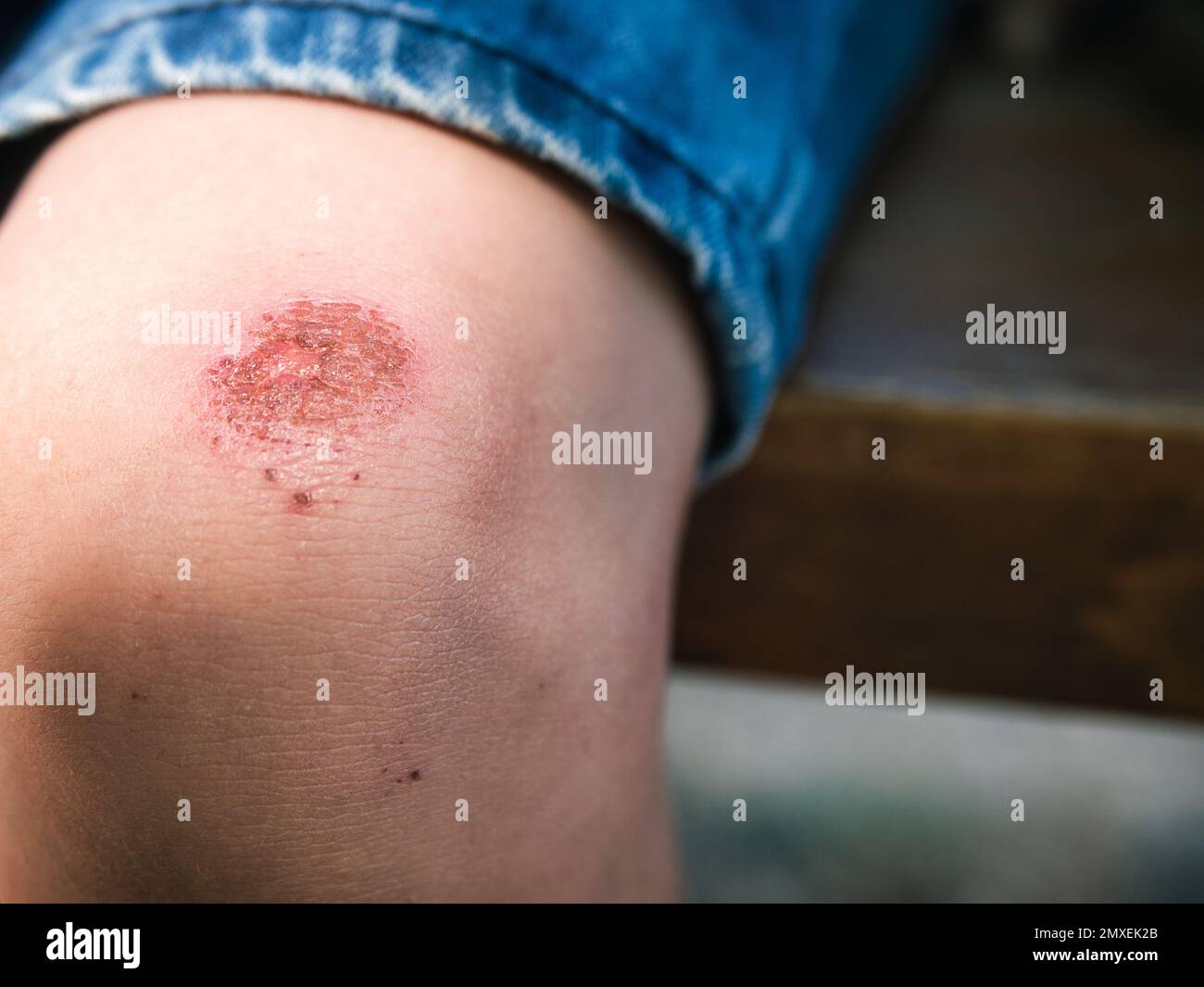 Scab teenager hi-res stock photography and images - Alamy