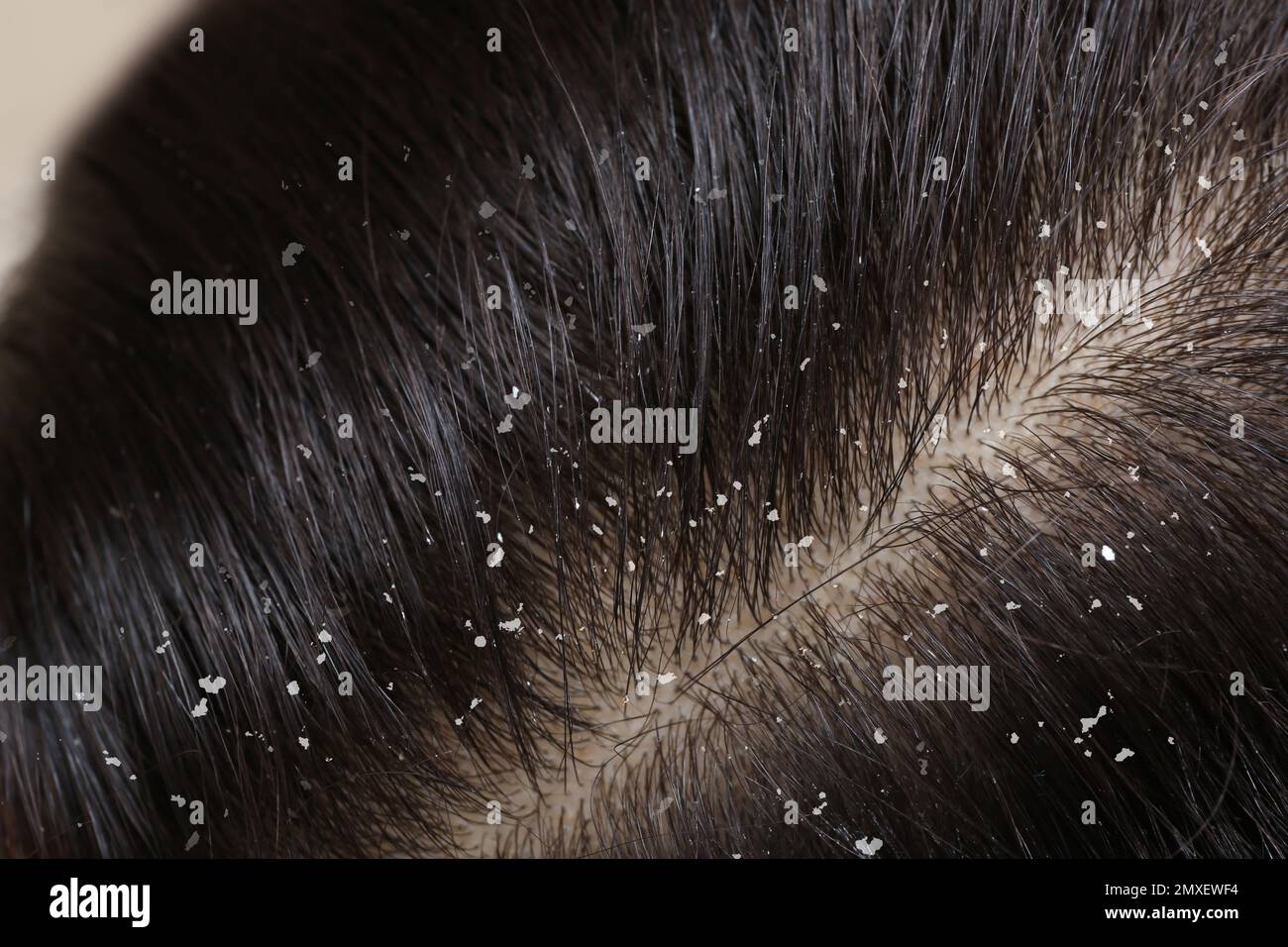 Woman dandruff shampoo hi-res stock photography and images - Alamy