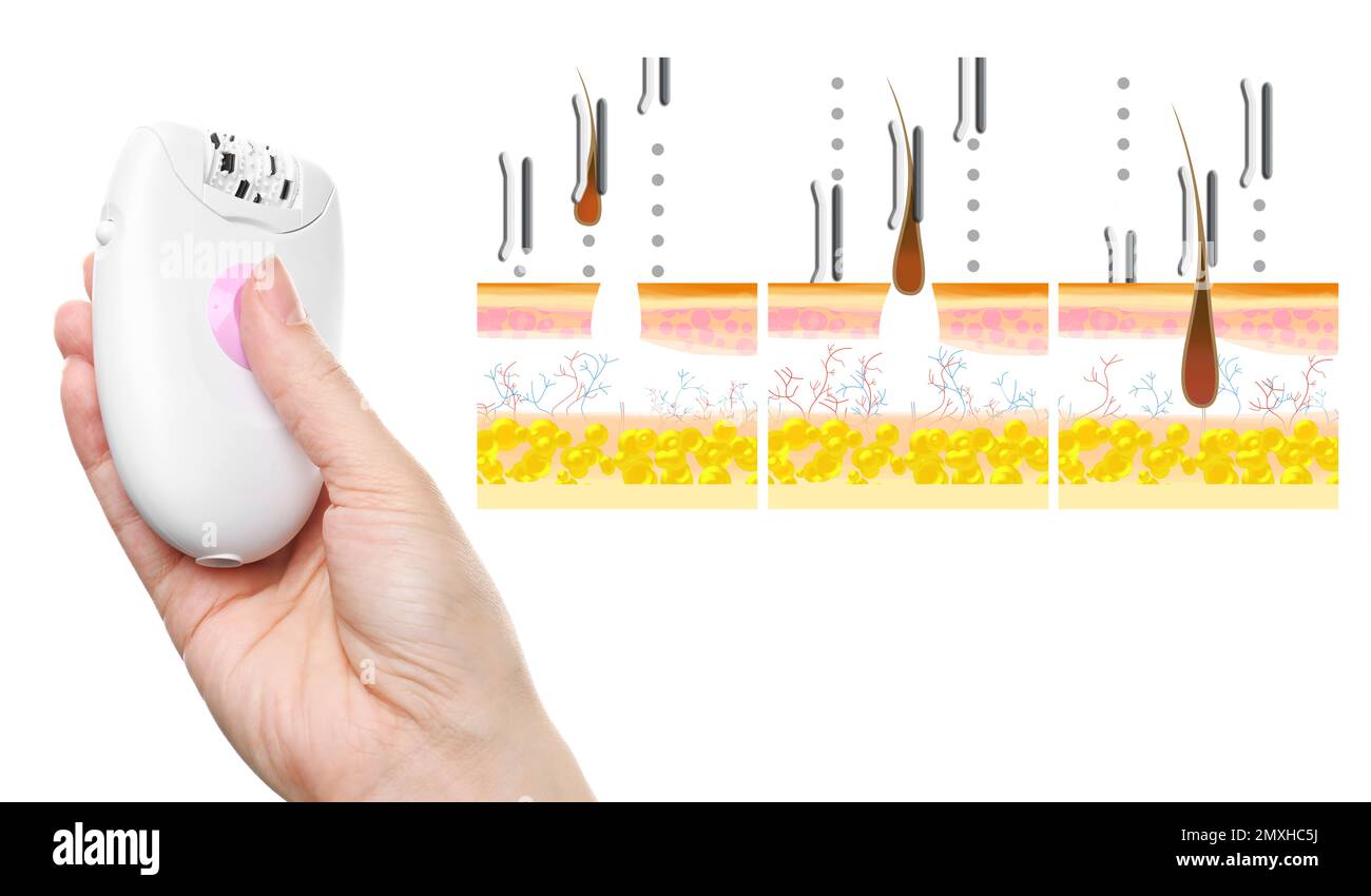 Epilation procedure. Woman holding modern appliance near illustrations ...
