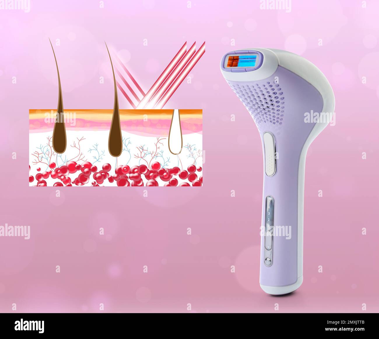 Epilation procedure. Modern appliance and illustration of hair ...