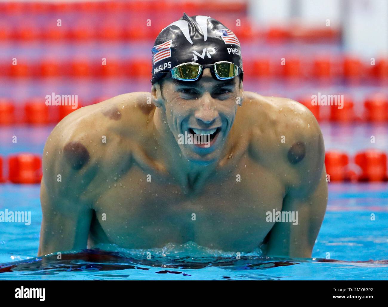 FILE - In this Tuesday, Aug. 9, 2016, photo "cupping" marks are seen on ...