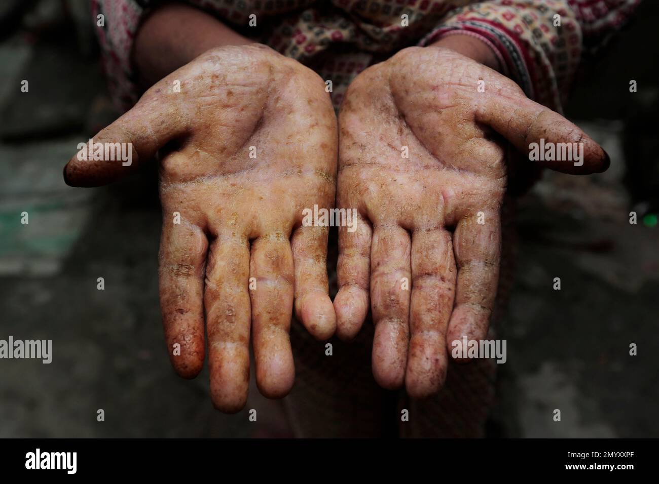 In this April 1, 2016 photo, Rashida Begum shows her palms, affected by ...