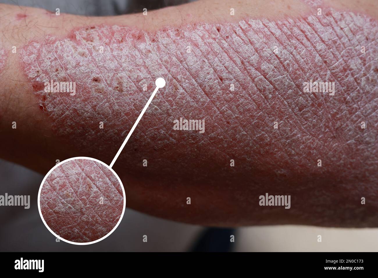 Macro detailed circles magnification of psoriasis skin, autoimmune ...