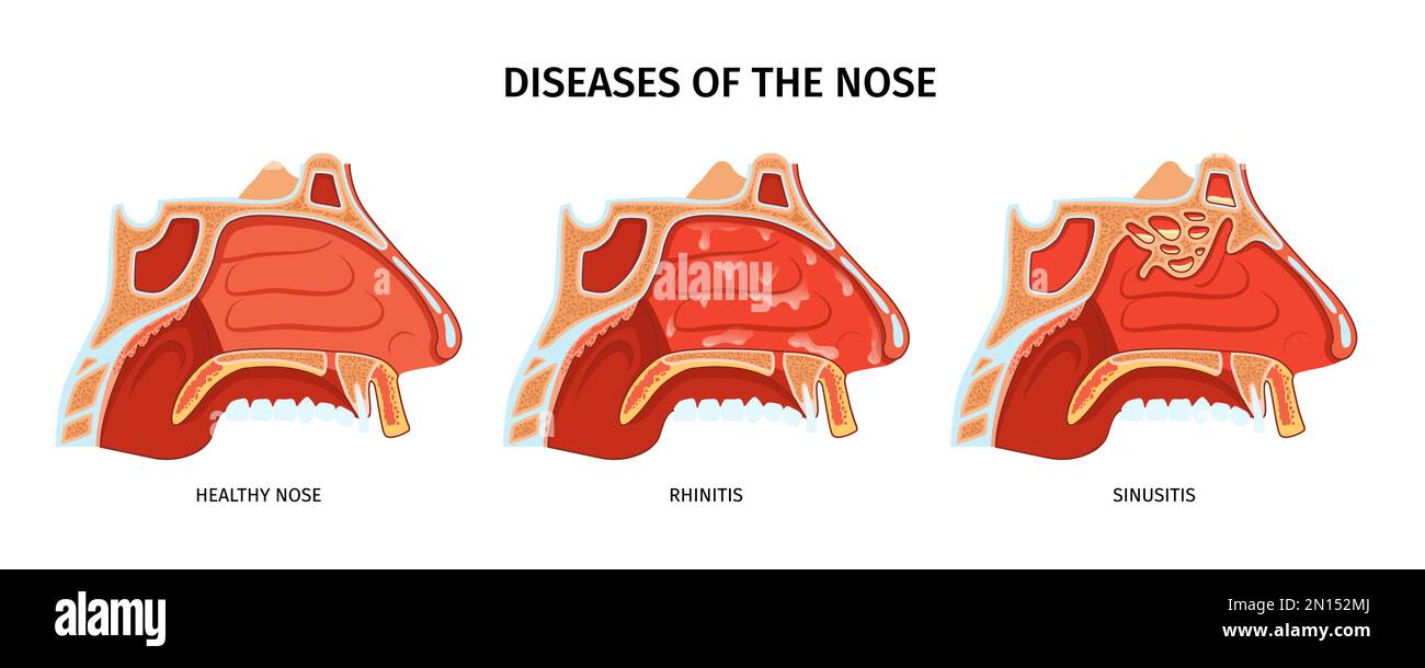 Diseases of nose anatomical cross section with healthy nose sinusitis and rhinitis realistic ...