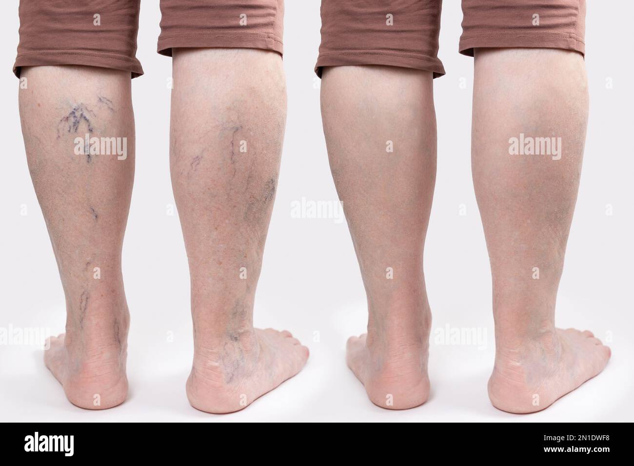Varicose veins before after hi-res stock photography and images - Alamy