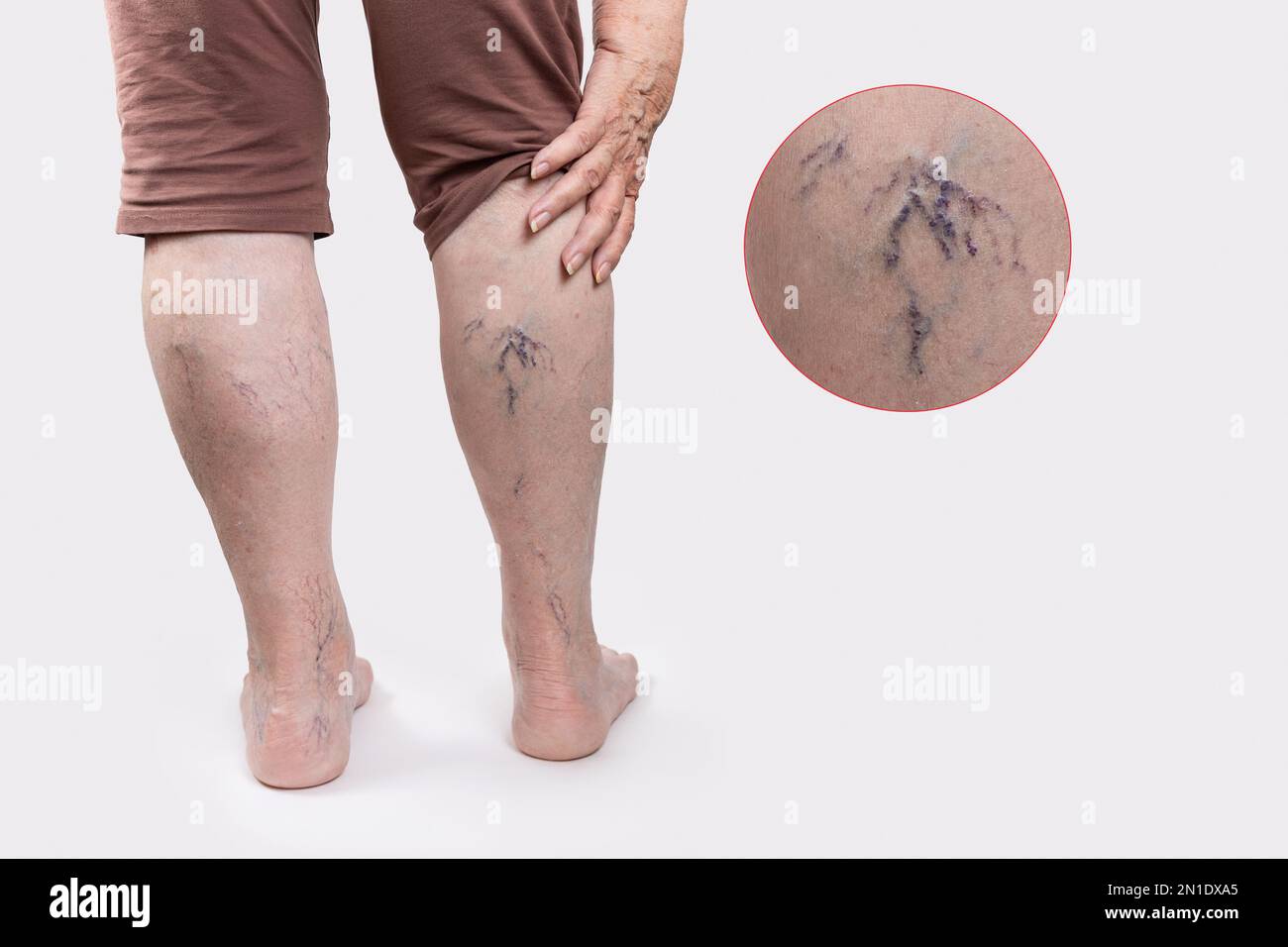 Varicosity. Close up view of old legs of woman with vascular asterisks ...