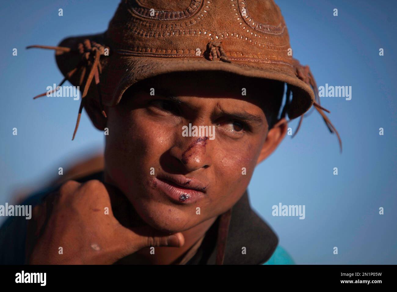 In this July 24, 2015 photo, Leo Andre's face is covered in cuts after ...