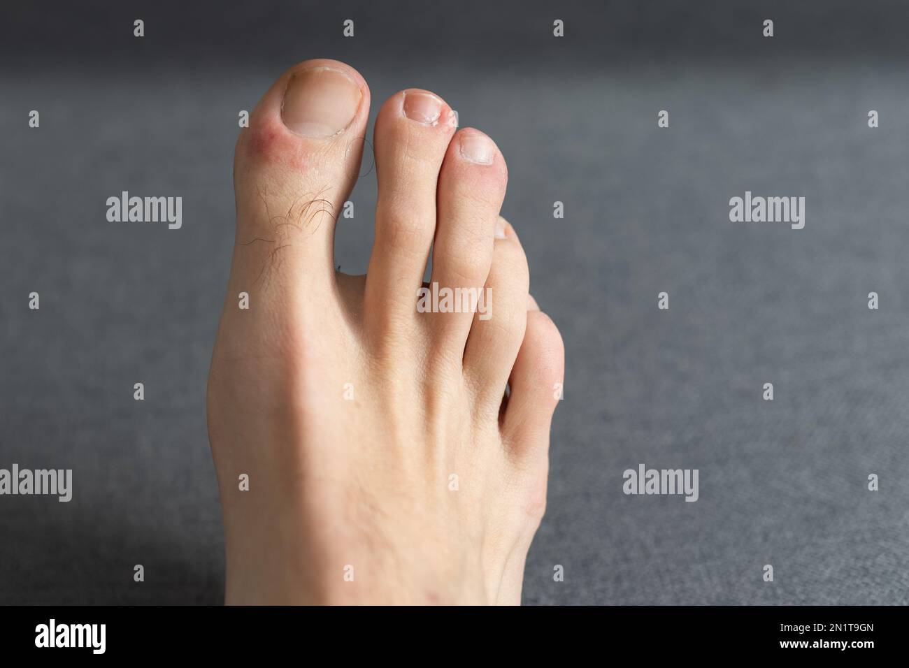 hair and wounds on male toes Stock Photo - Alamy
