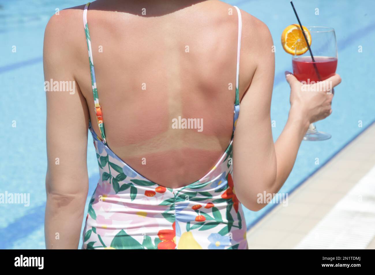 Sunburn And Skin Care Concept Young Woman With Red Sunburned Skin On