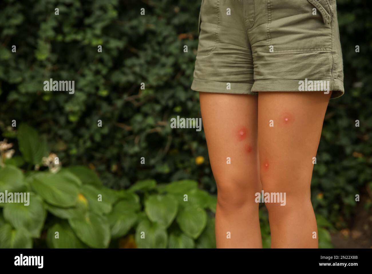 Woman with insect bites on legs in park, closeup. Space for text Stock ...