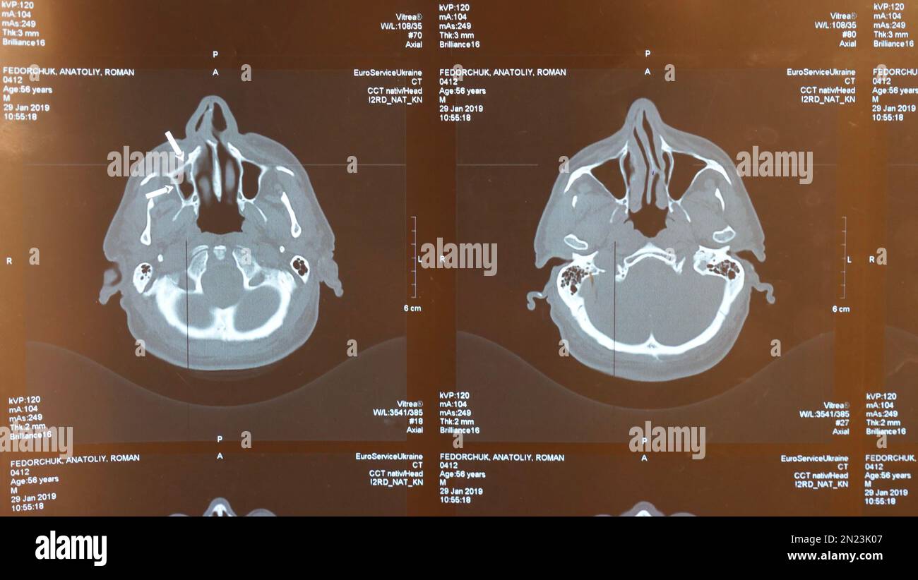 Magnetic resonance imaging of an older man's brain after a traumatic ...