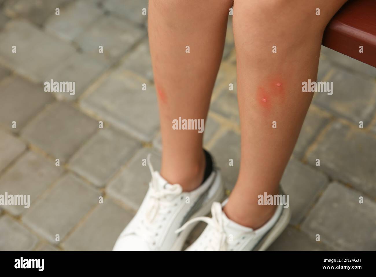 Girl with insect bites on legs outdoors, closeup Stock Photo - Alamy