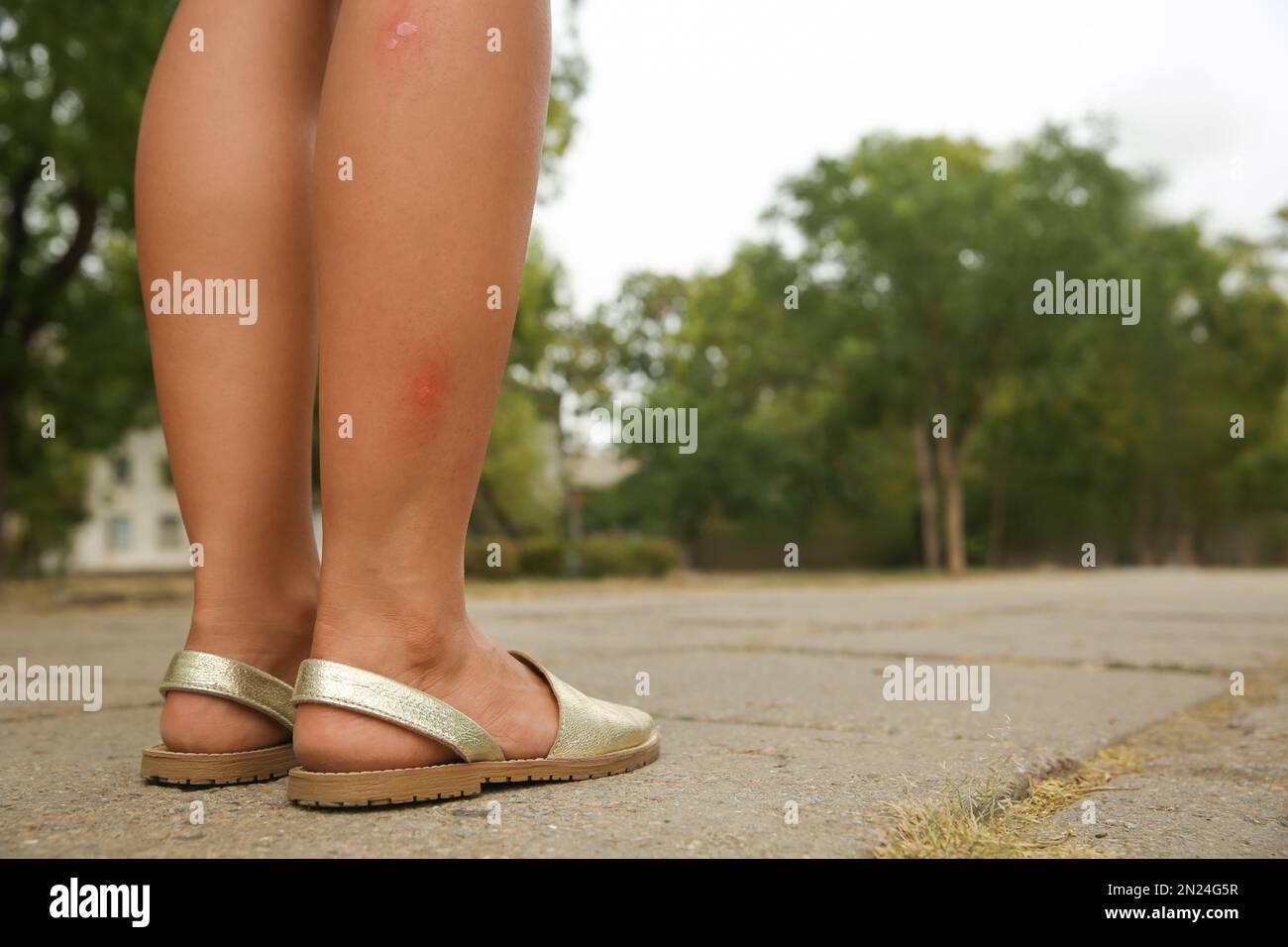 Woman with insect bites on legs in park, closeup. Space for text Stock ...