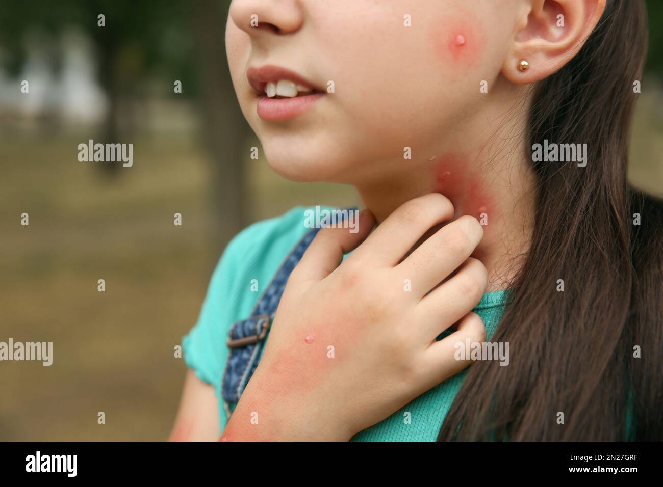 Girl scratching neck with insect bites in park, closeup Stock Photo - Alamy