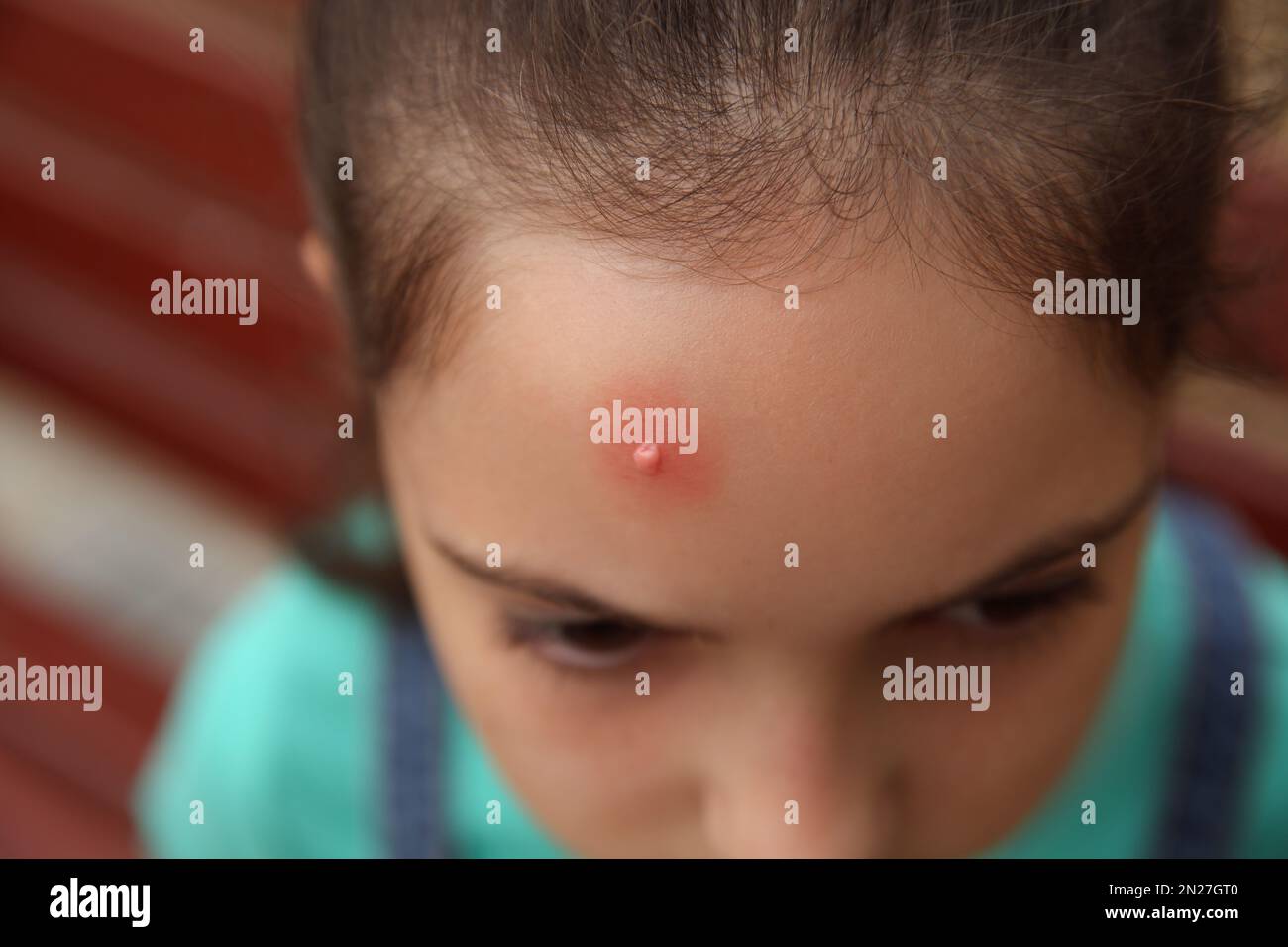 Girl with insect bite on forehead outdoors, closeup Stock Photo - Alamy