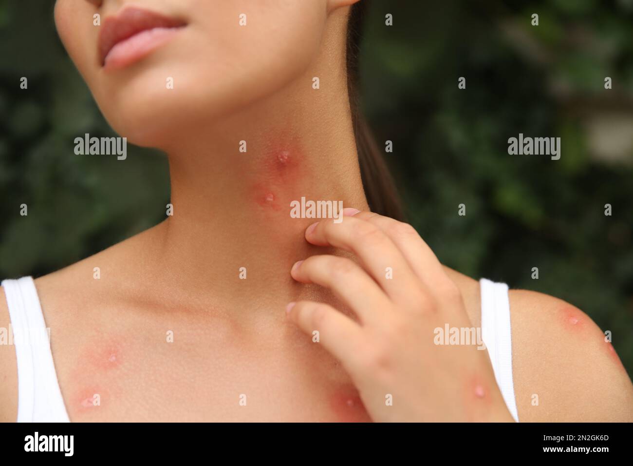 Neck rash hi-res stock photography and images - Alamy