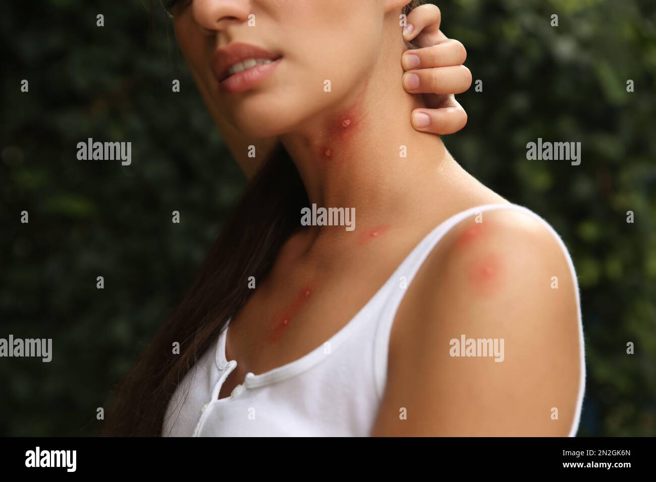 Woman scratching neck with insect bites in park, closeup Stock Photo ...