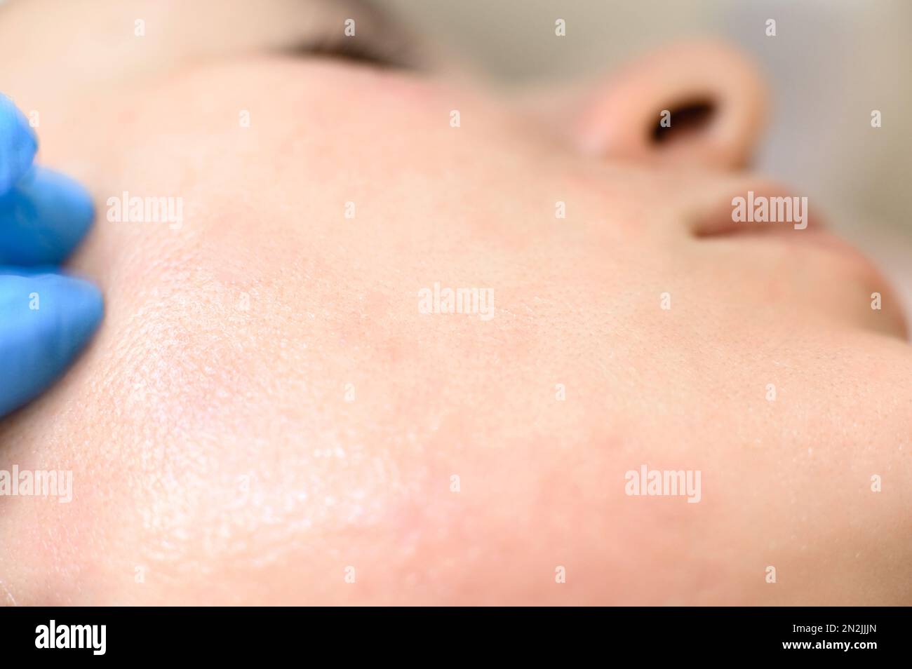 Close-up of facial skin with visible open pores, a visit to a beautician Stock Photo - Alamy