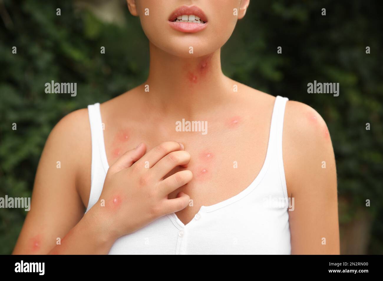 Insect bites woman hi-res stock photography and images - Alamy