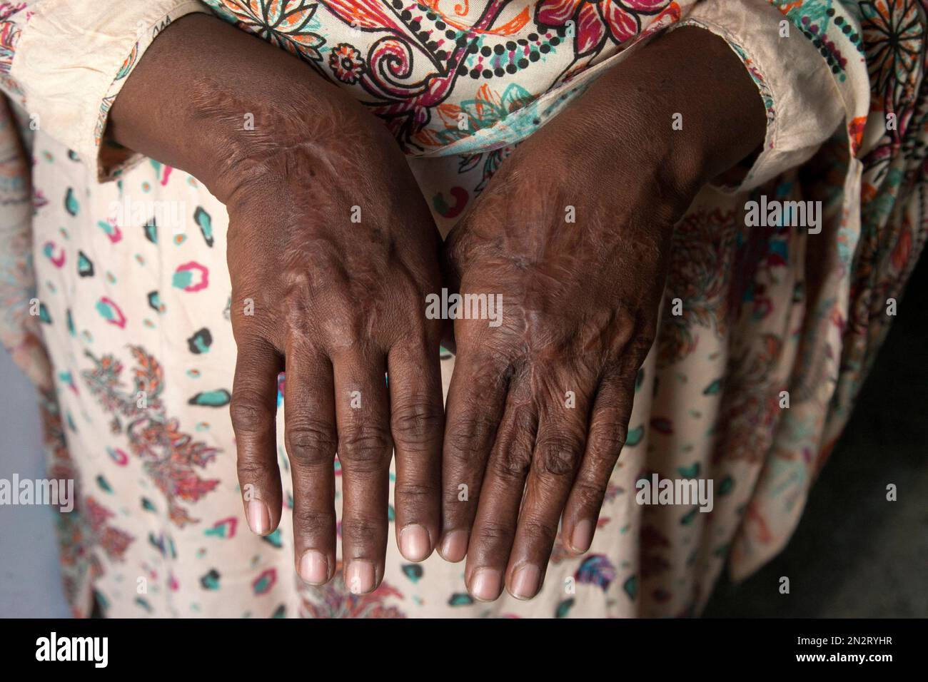 In this Friday, March 6, 2015 photo, Pakistani acid attack survivor ...