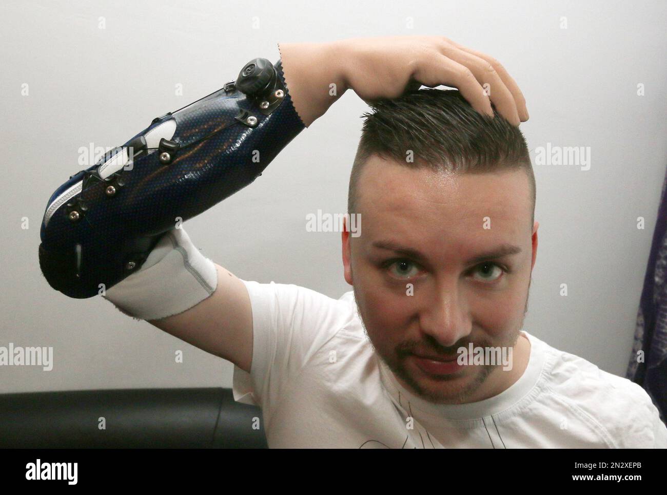 Milorad Marinkovic shows his bionic arm as he poses for a photograph at ...