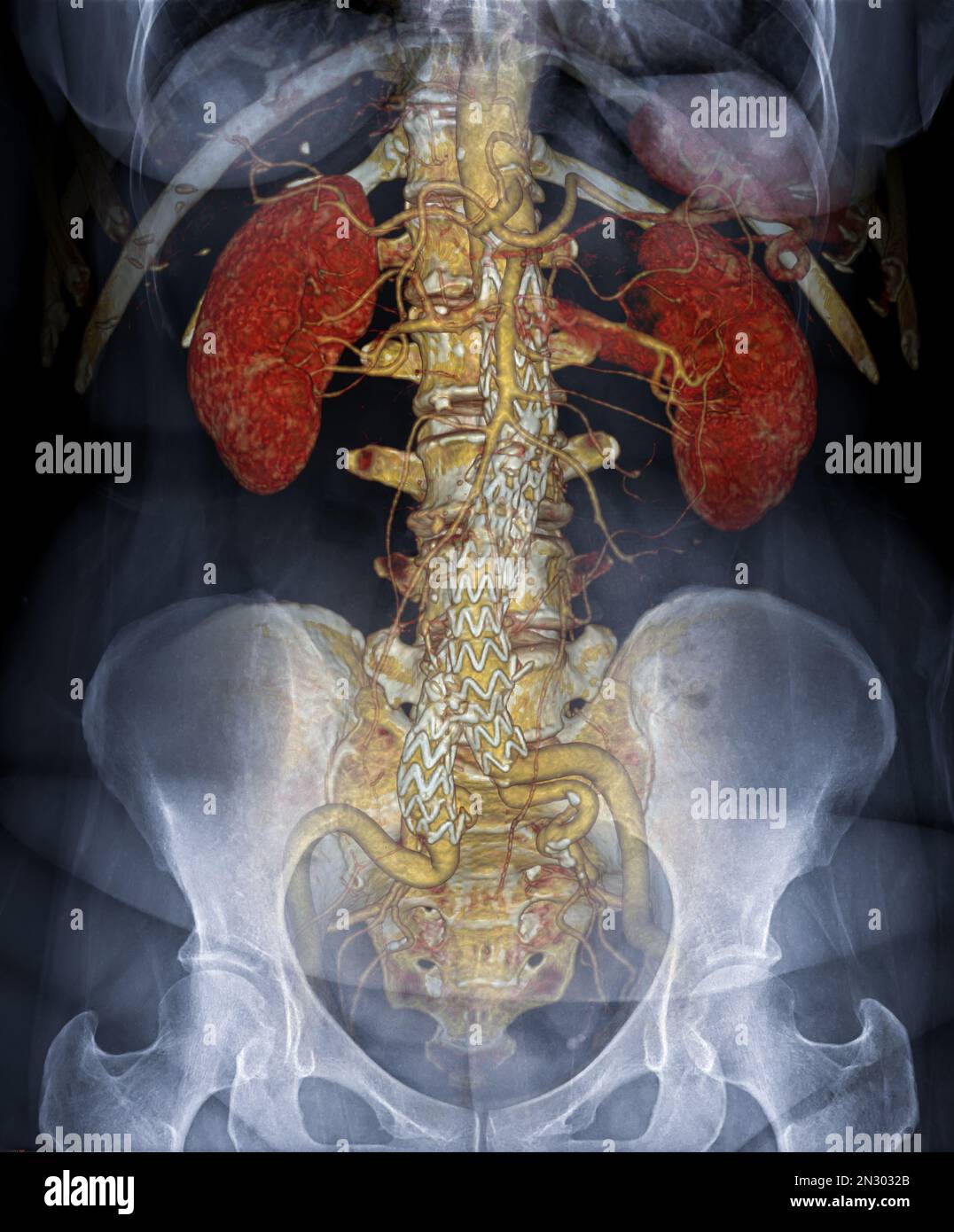 Ct angiography abdomen hi-res stock photography and images - Alamy