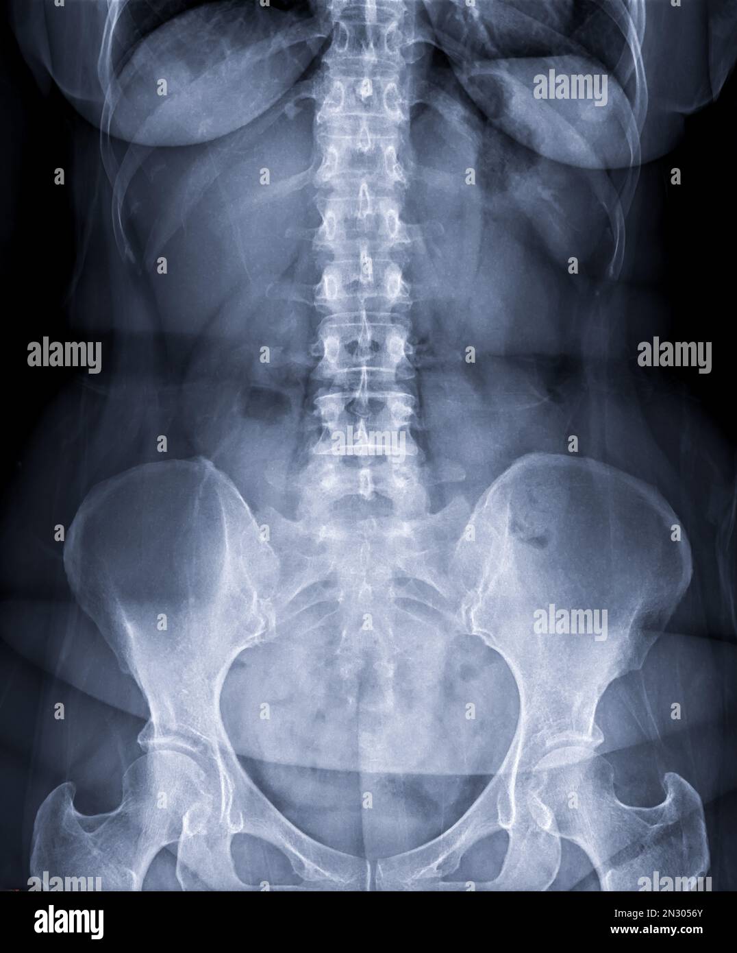 X-ray image of lumbar Spine or L-s spine front view for diagnosis lower ...