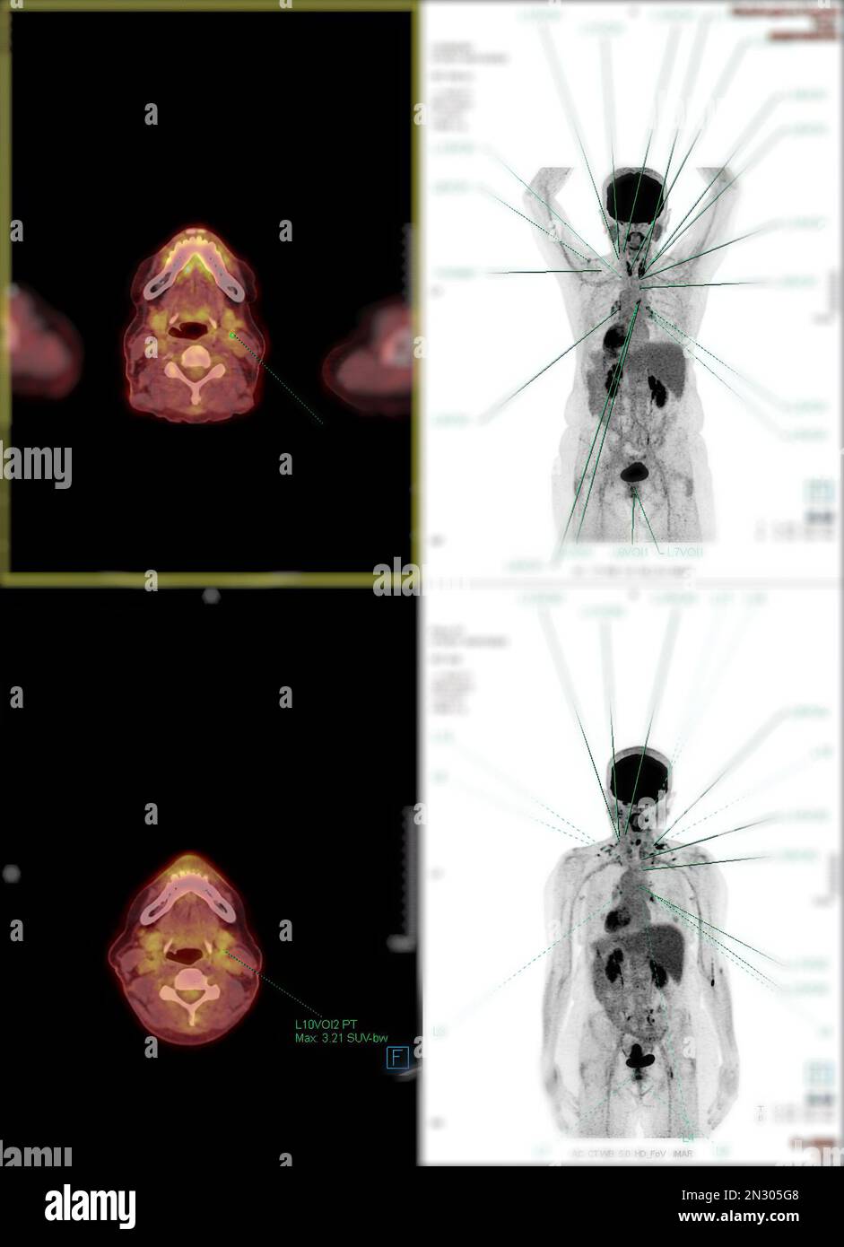 Positron emission tomography (PET) CT scan uses a radioactive drug ...