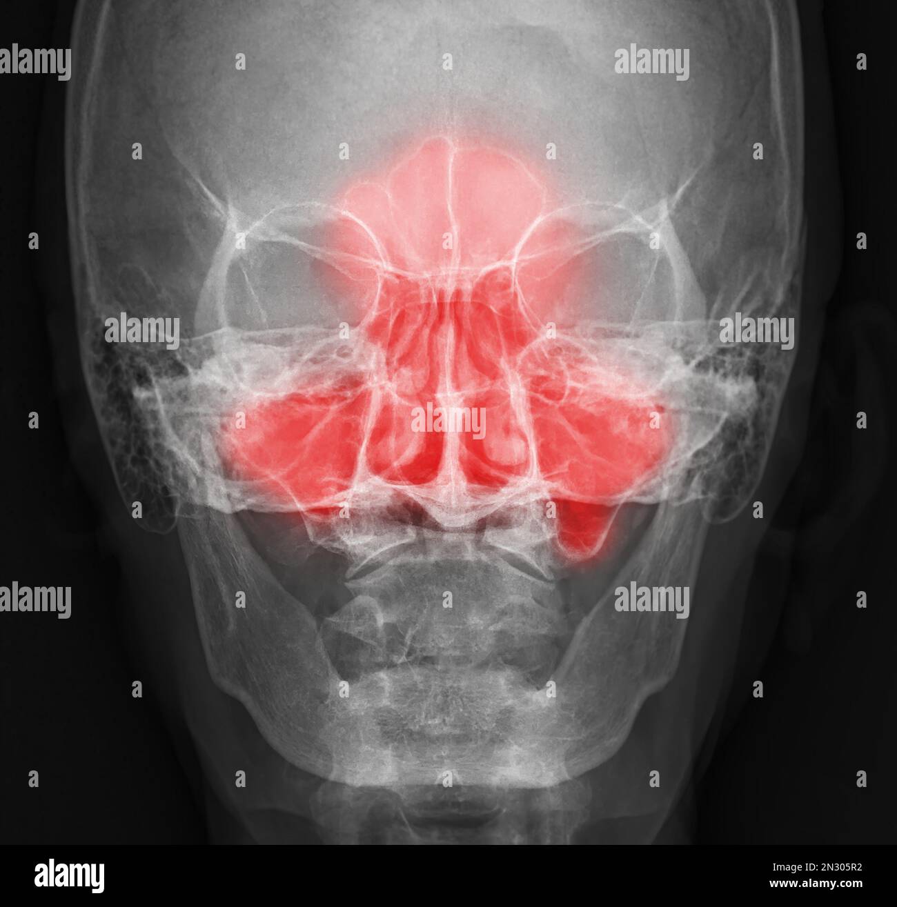 x-ray image of paranasal sinuses for diagnosis sinusitis Stock Photo - Alamy