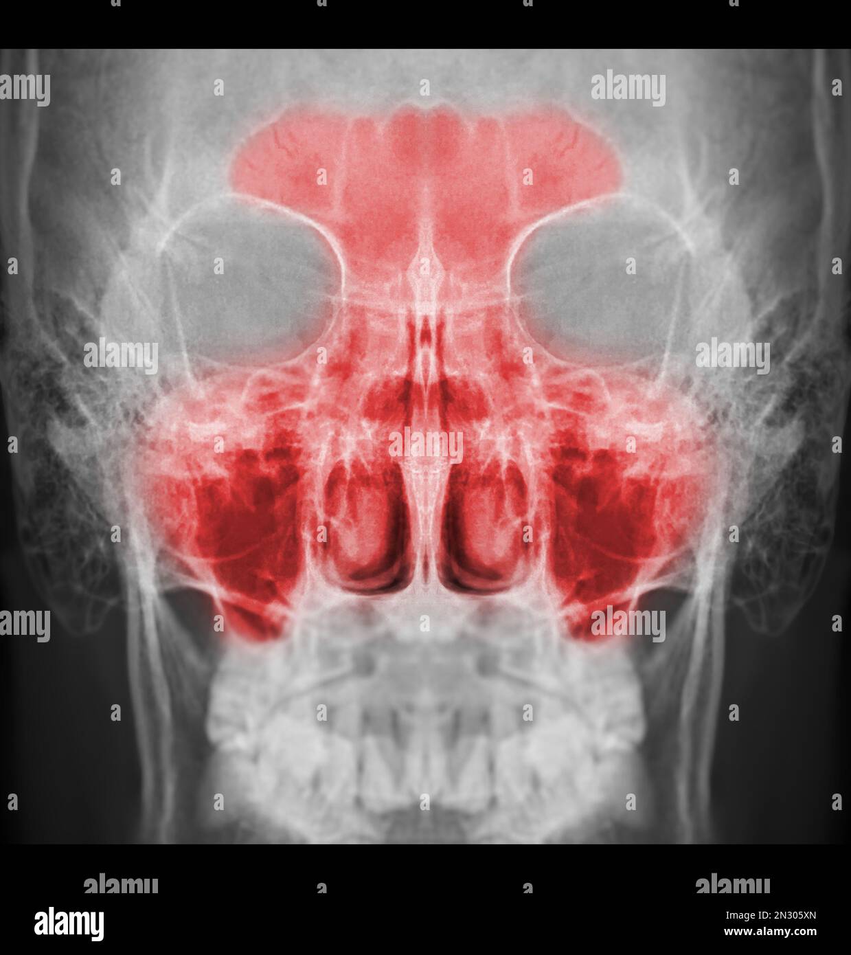 Paranasal sinuses hi-res stock photography and images - Alamy