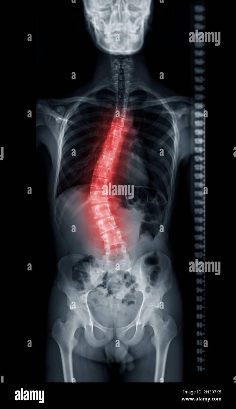 X-ray image of Whole Spine for diagnosis scoliosis of spine Stock Photo ...